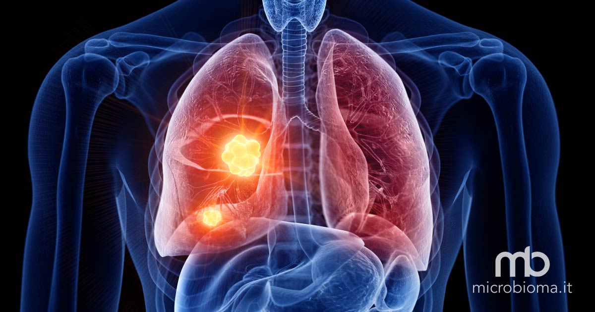 Microbiota del cavo orale possibile biomarker per tumore ai polmoni nei ...