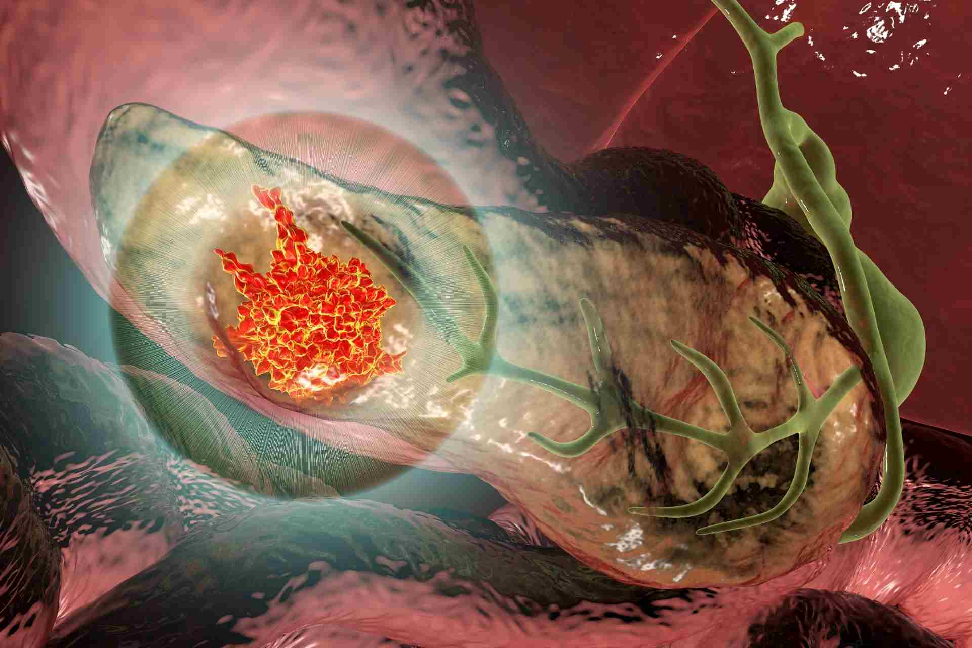 Tumore al pancreas: metabolita microbico intestinale migliora l ...