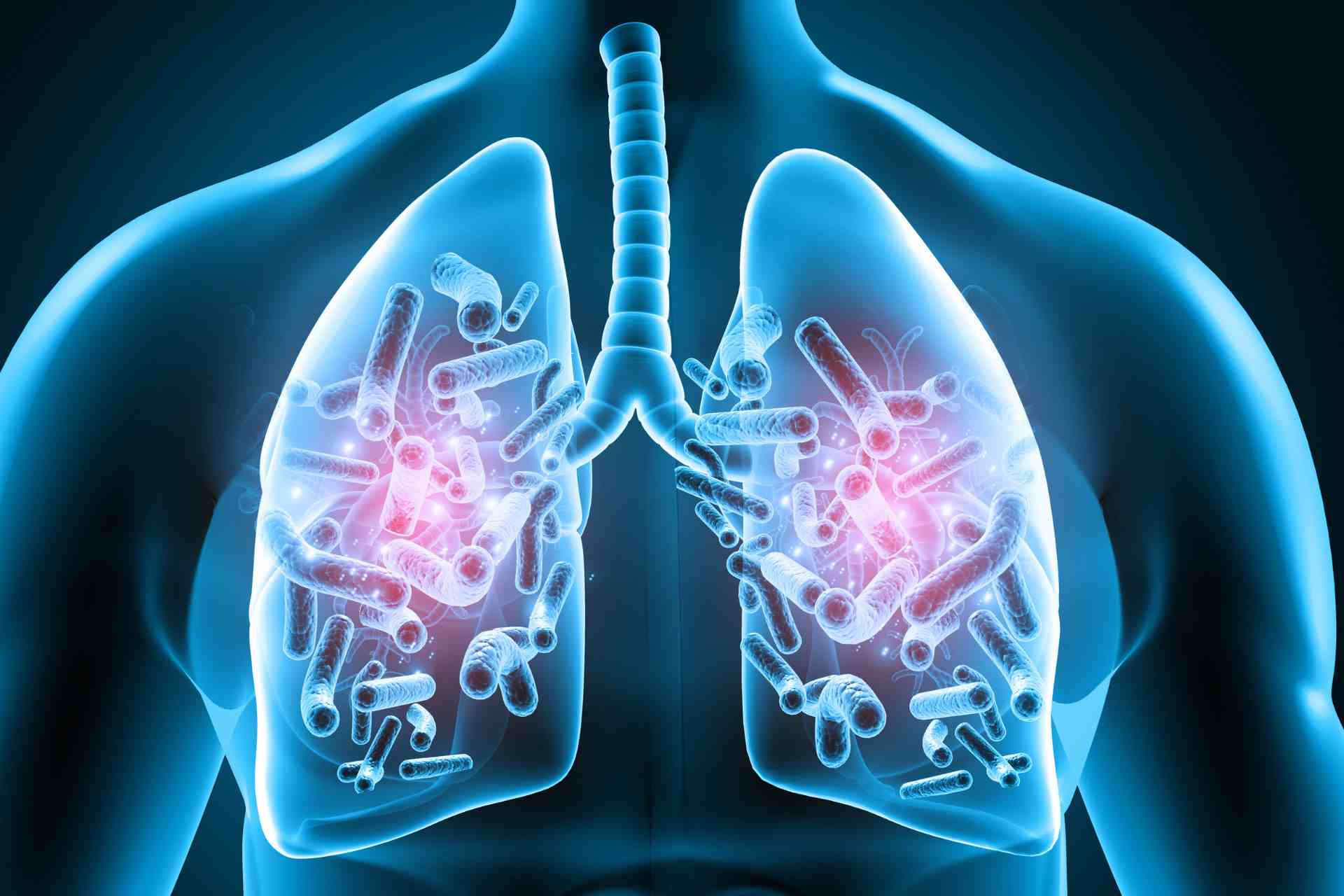 Polmonite da legionella: gravità dipende da microbiota respiratorio